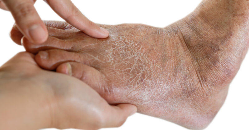 Tissue Paper Skin | AMERIGEL Advanced Skin & Wound Care