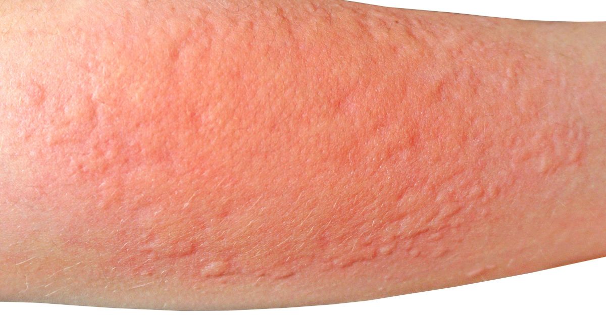 Diabetic Skin | AMERIGEL Advanced Skin & Wound Care