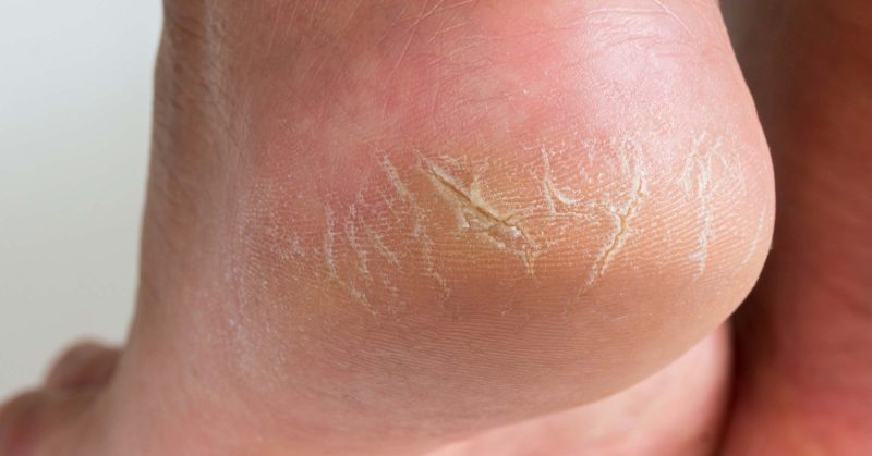 Xerosis | AMERIGEL Advanced Skin & Wound Care